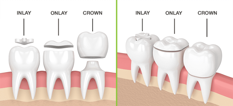 Onlays and Inlays – TSJ SMILE DENTAL GROUP